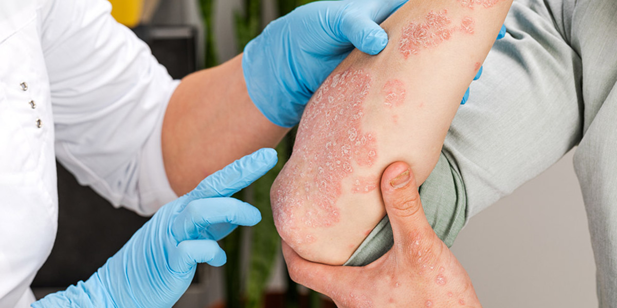 Dit zijn de mogelijke pistes om psoriasis te behandelen. - Pazzox