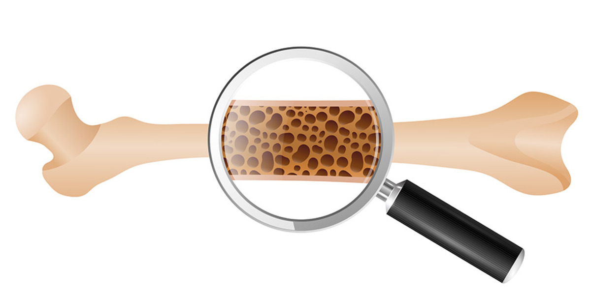 Osteoporose symptomen - Pazzox, online apotheek zonder zorgen