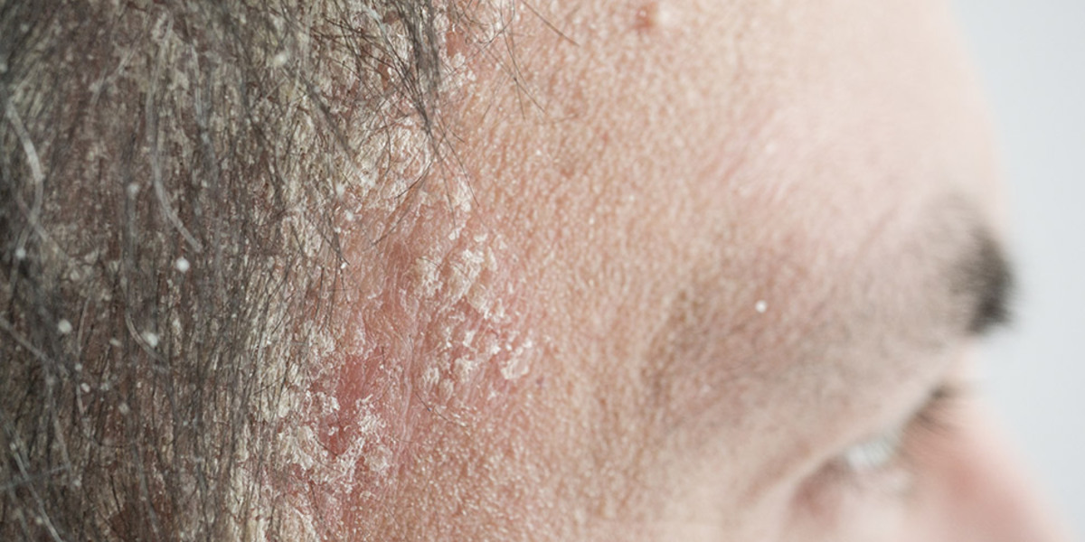 Wat kan je doen tegen seborroïsch eczeem op de hoofdhuid? - Pazzox